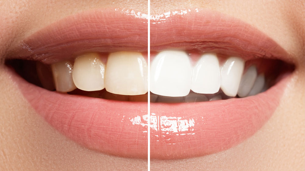 Oral health of vape, can a dentist tell if you smoke vapes?